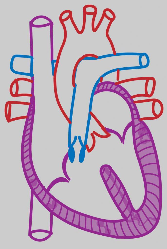 Tetralogy of Fallot – ACHD NZ